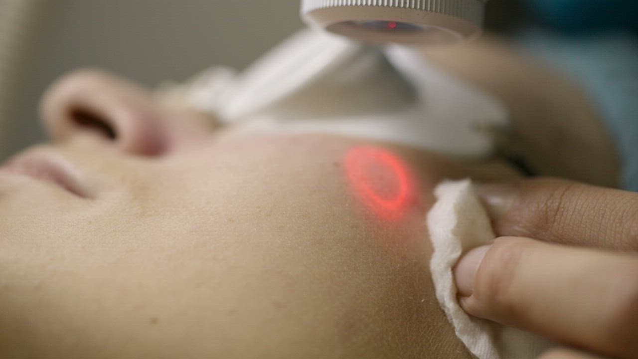 Woman having skin laser treatment - Free Stock Video