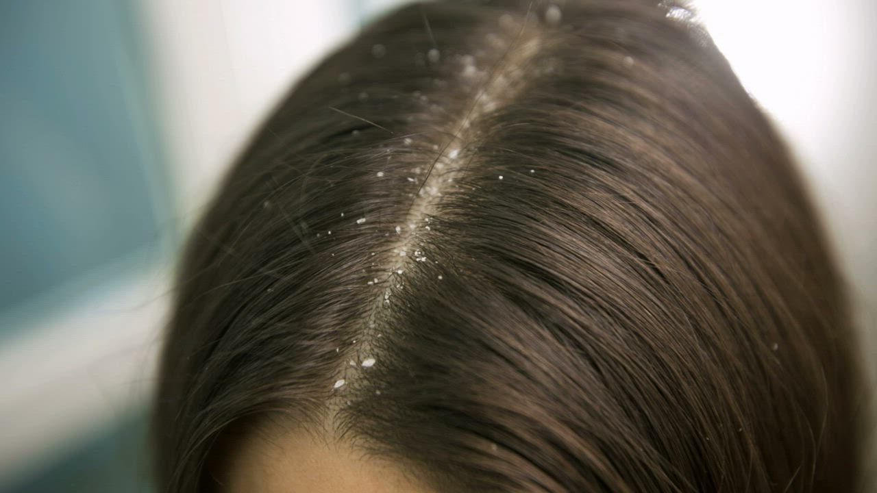 Woman with dandruff in hair, close up - Free Stock Video