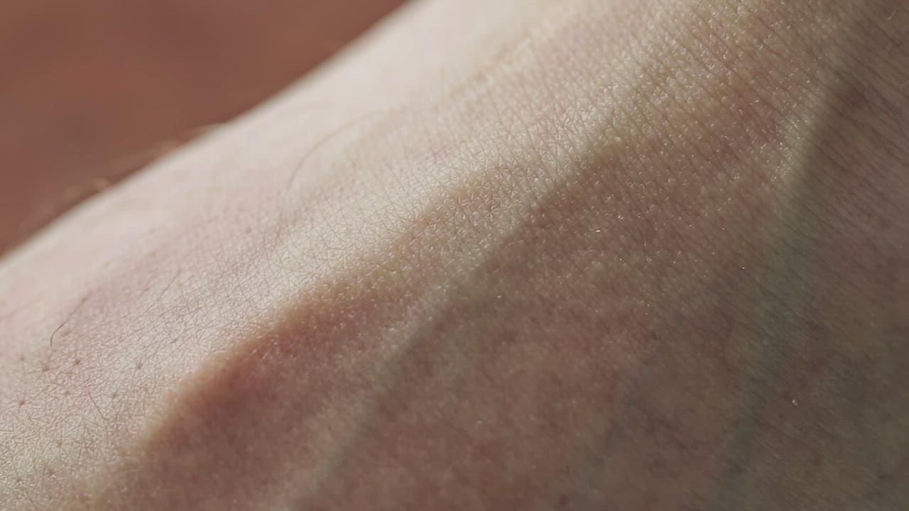 Close up of a pulsating vein under skin - Free Stock Video