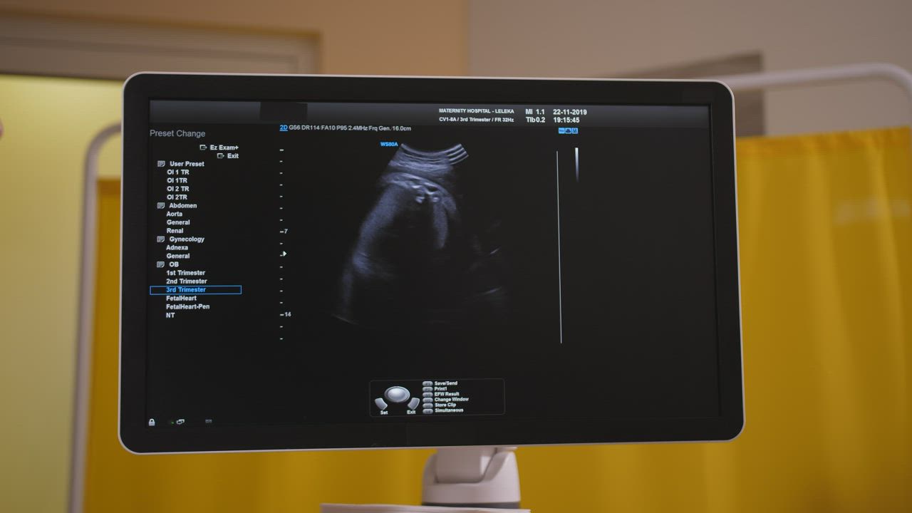 Ultrasound scan on a monitor - Free Stock Video